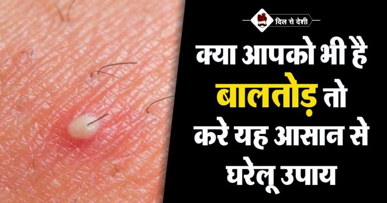 baltod treatment Archives | Dil Se Deshi